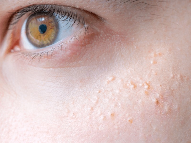 kin Tag Removal London | Dermatologist-Led Skin Tag Treatment – London