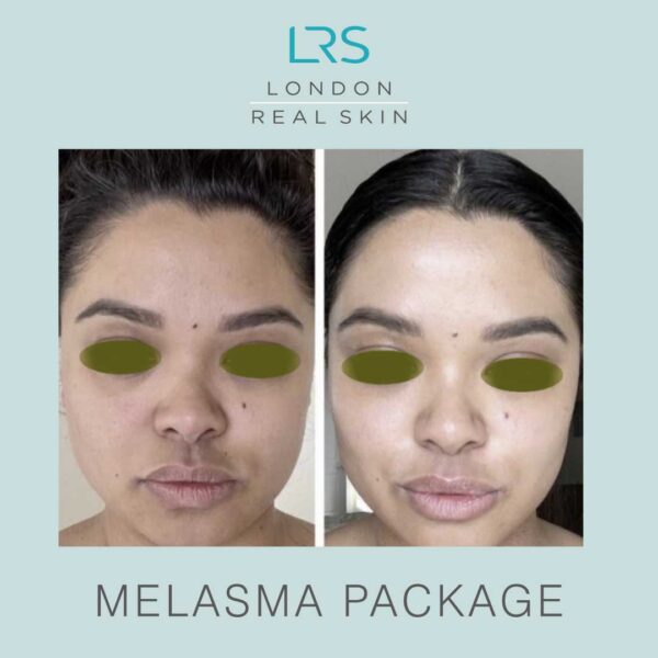 Melasma Package - London Real Skin Clinic | London Real Skin Clinic